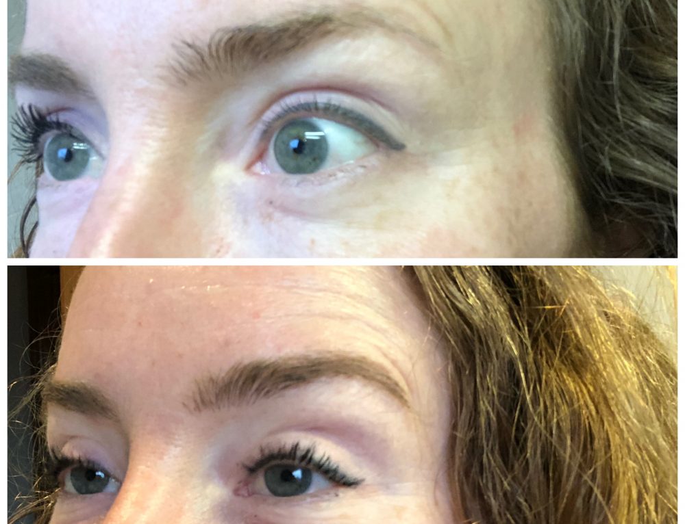 Does electrolysis cause scarring? – Barebella Beauty